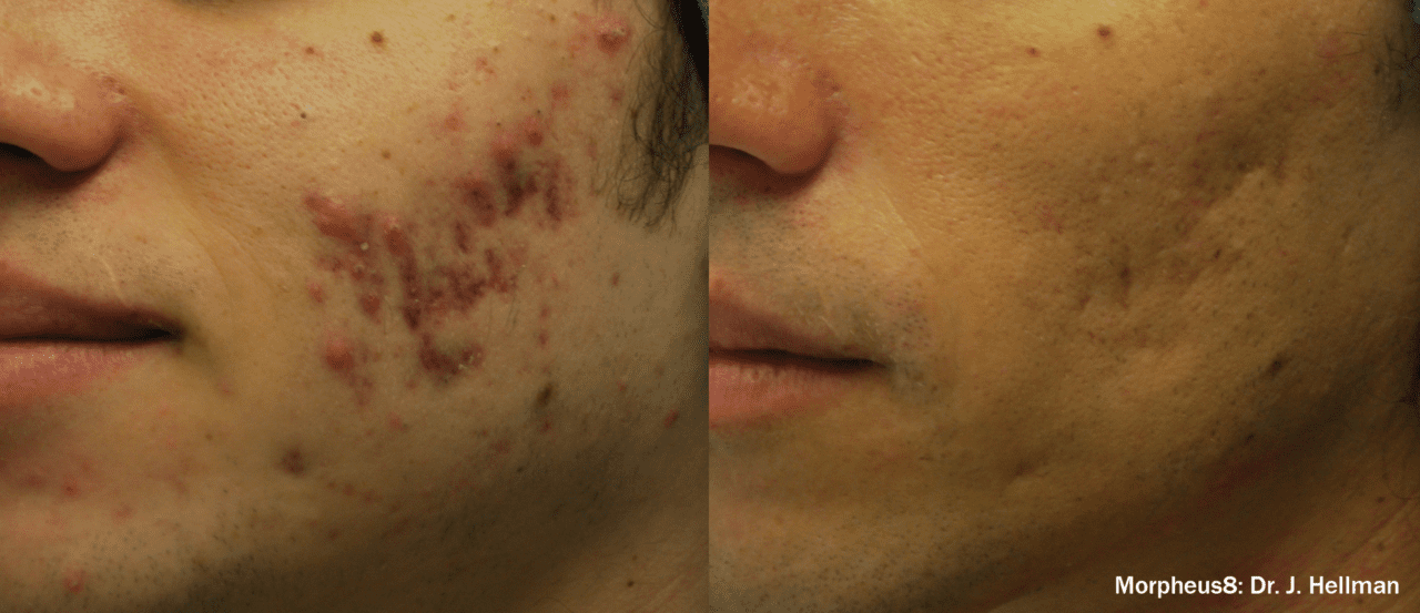 Morpheus8 radio-frequency micro-needling before and after picture