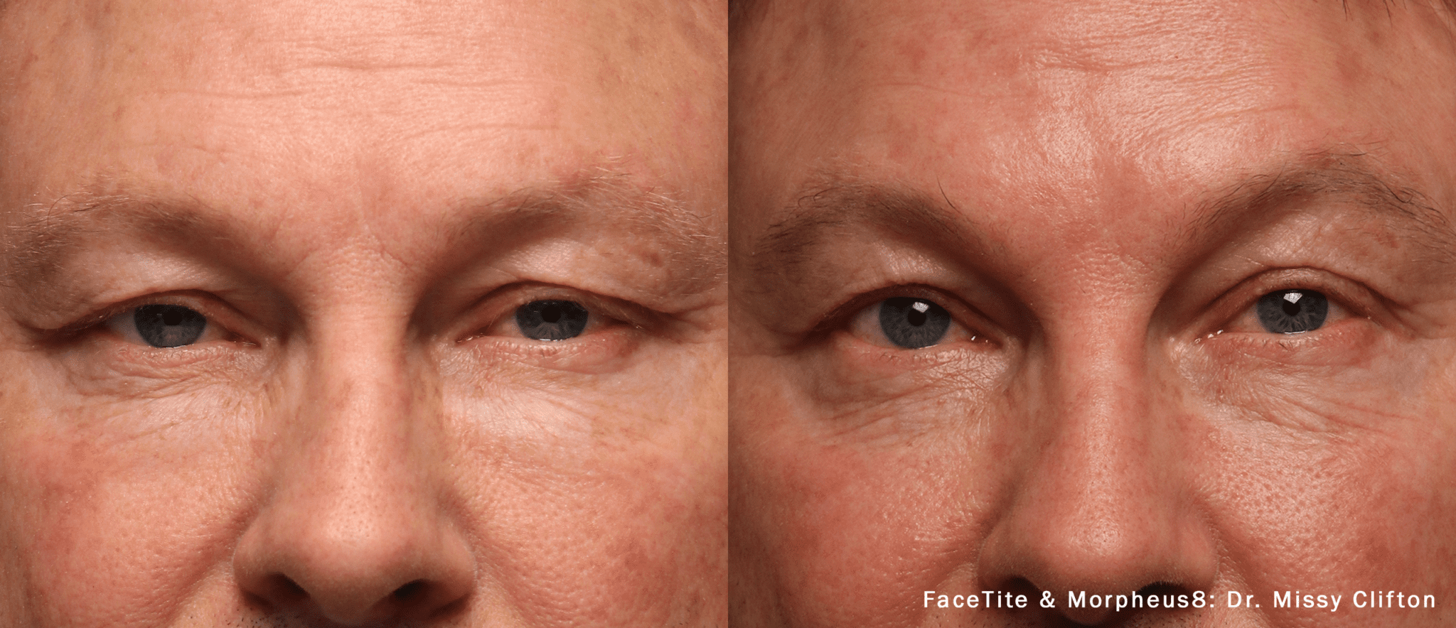 Morpheus8 radio-frequency micro-needling before and after picture