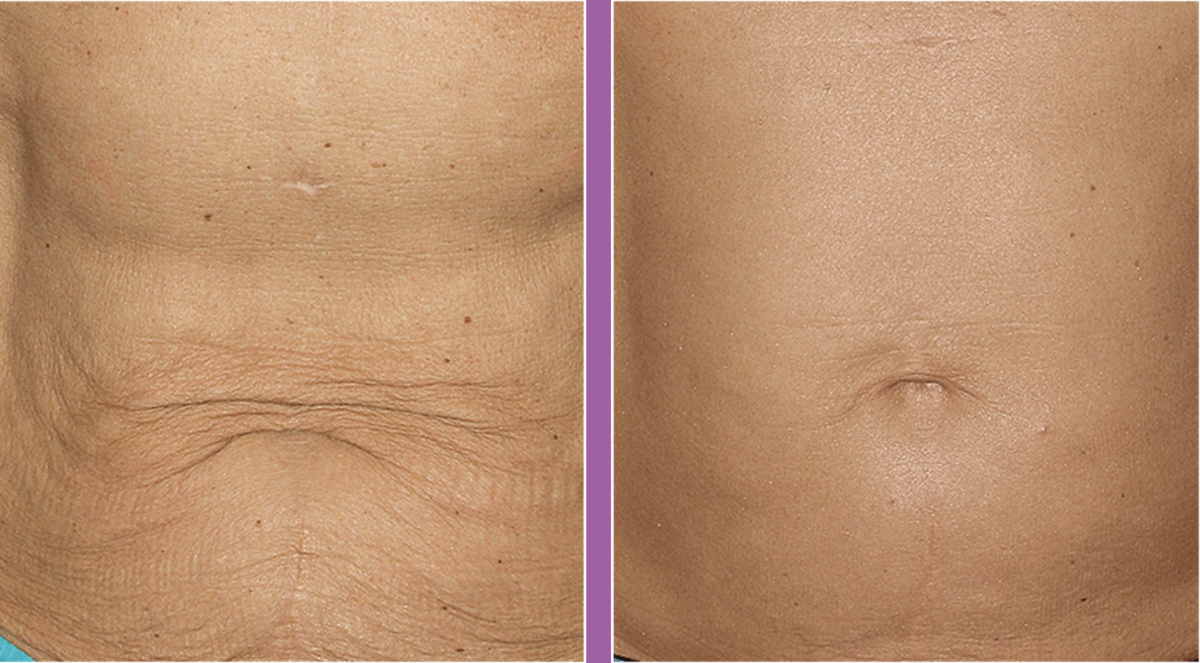 Thermage Before and After Pictures