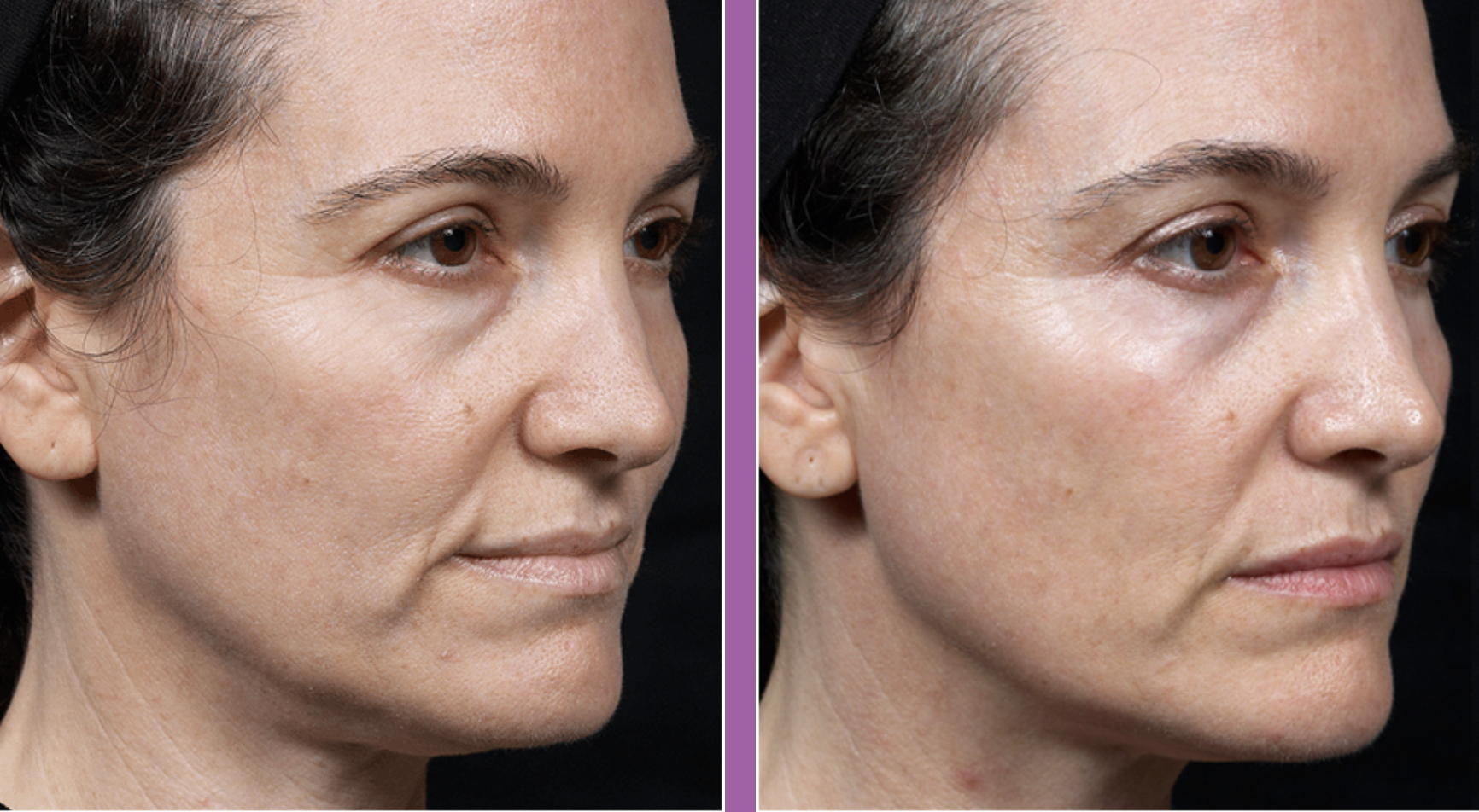 Everything You Need To Know About Thermage FLX