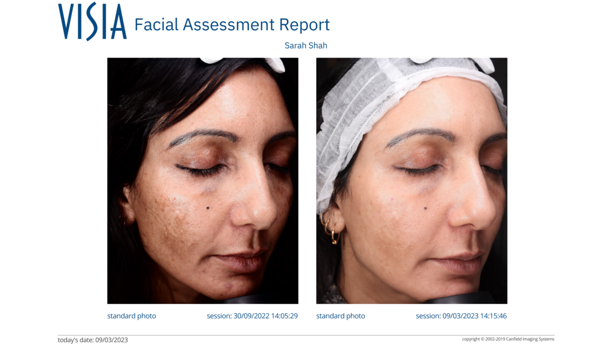 Derma Revive Transformations: Cosmelan Peel