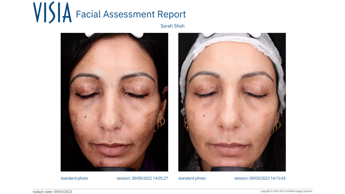 Derma Revive Transformations: Cosmelan Peel