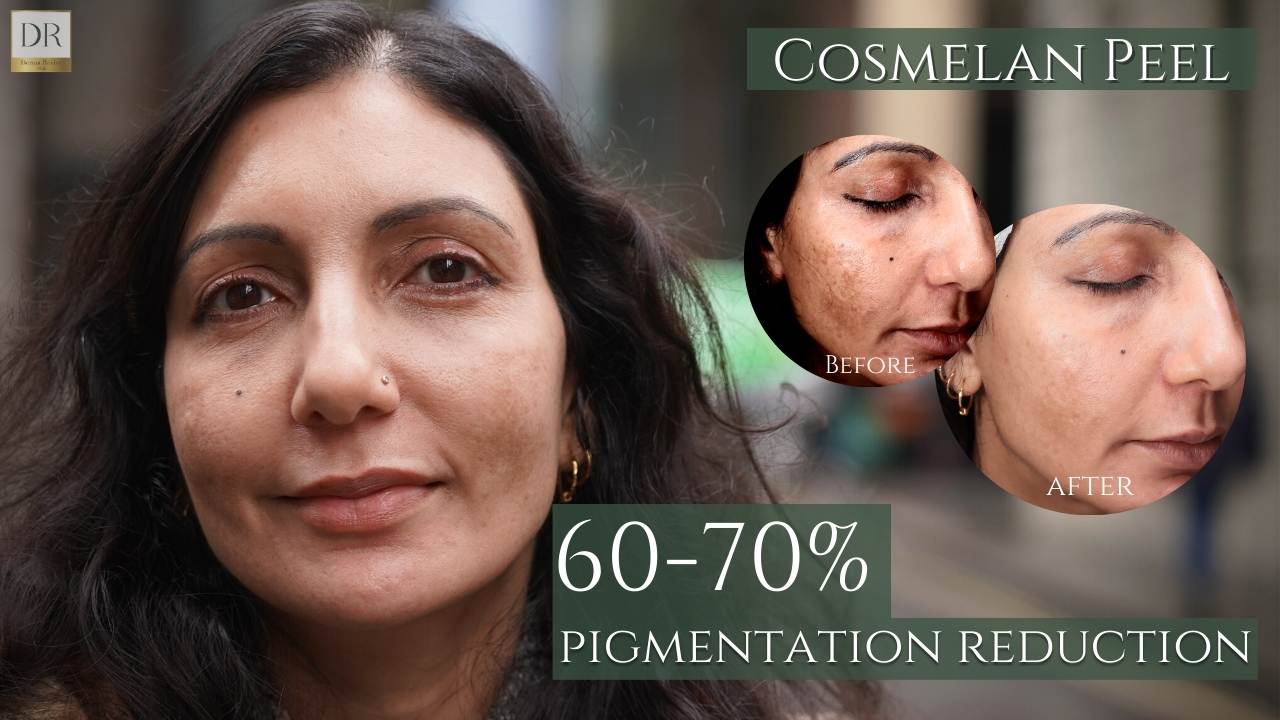 Derma Revive Transformations: Cosmelan Peel
