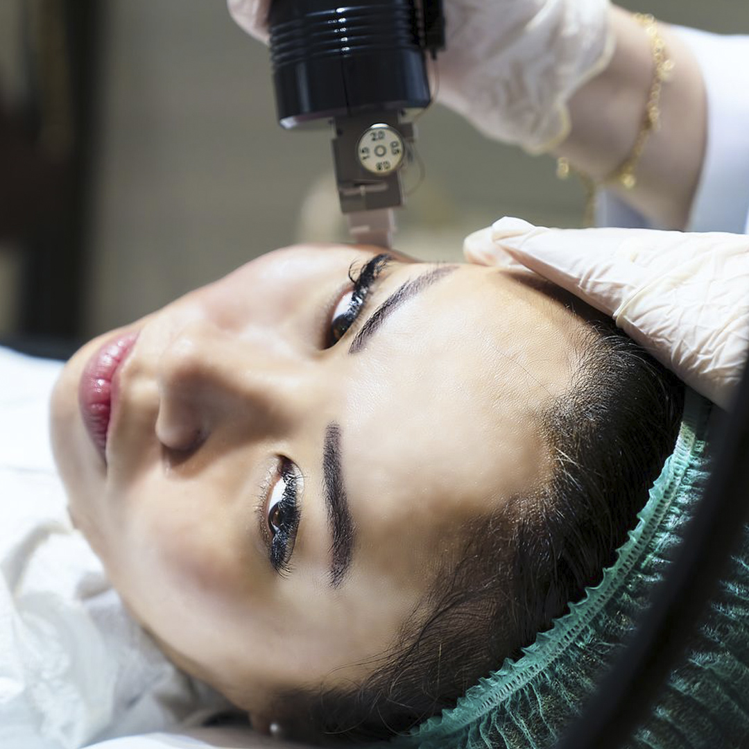 RF Microneedling with Intracel - Derma Revive Skin Clinic