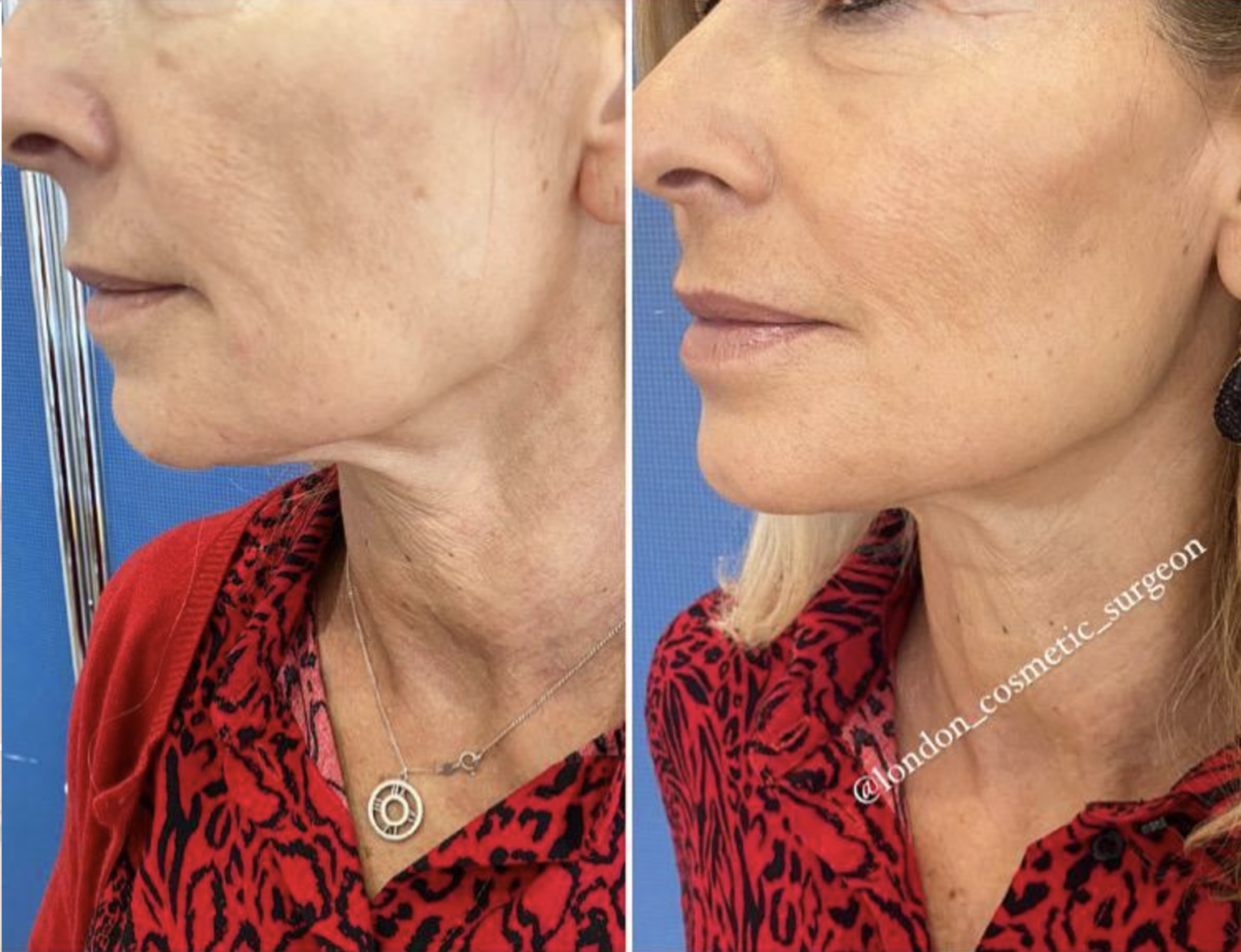Endolift: Non-Surgical Face Lift - Derma Revive Skin Clinic