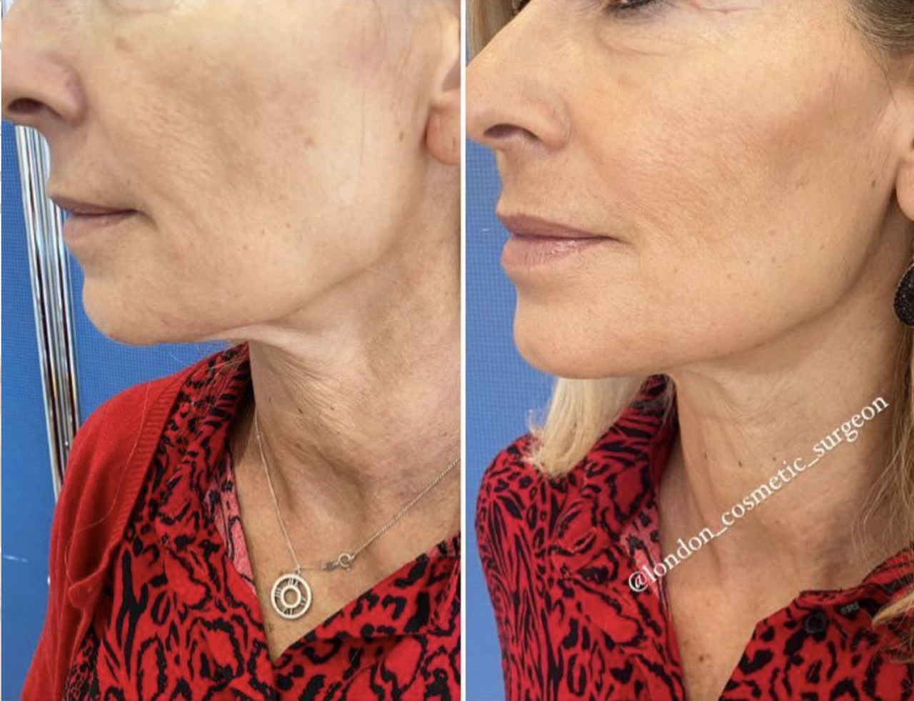 Endolift: Non-Surgical Face Lift - Derma Revive Skin Clinic