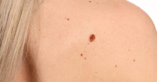 Skin Lesions - What Are They, Types, Causes, Diagnosis & Treatment ...