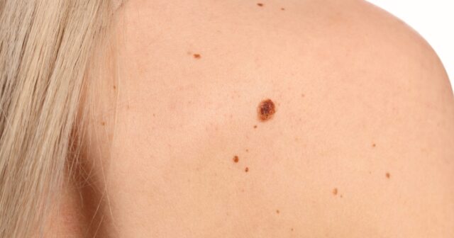 Skin Lesions - What Are They, Types, Causes, Diagnosis & Treatment ...