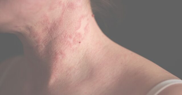 LED Light Therapy For Eczema - Derma Revive Skin Clinic