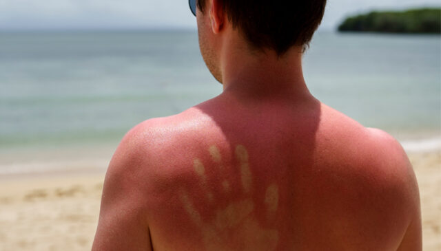 Can You Recover from Sun Damage? - Derma Revive Skin Clinic