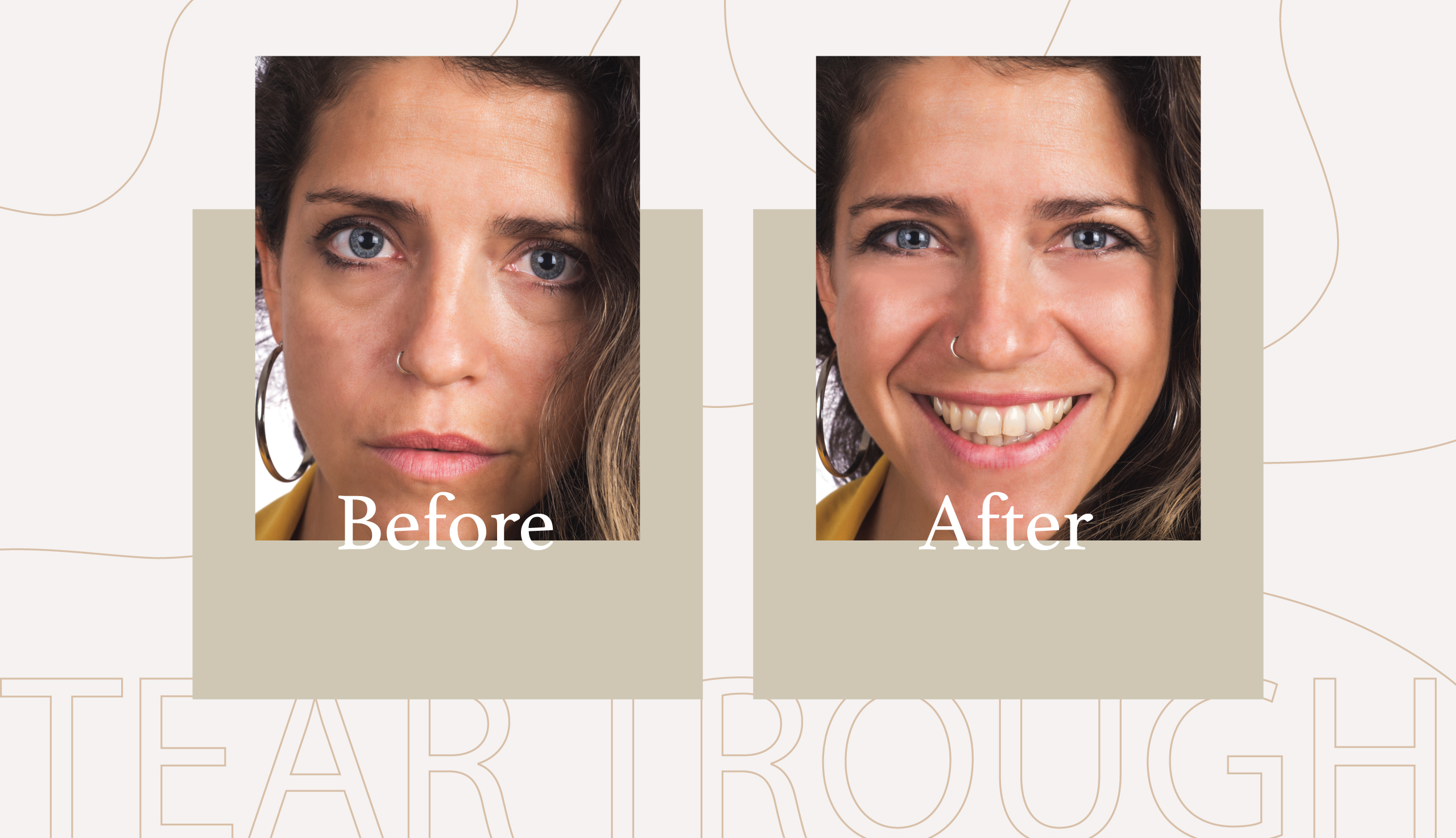 Are Tear Trough Fillers the Answer to Dark Circles? - Derma Revive Skin ...